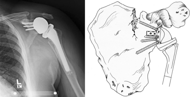 在metaglene中央笼上方或下方使用螺钉逆行全肩关节置换术中肩胛骨骨折的发生率:临床和生物力学结